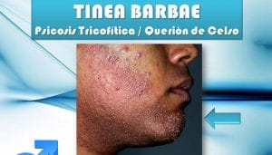 Tinea Barbae: Características, Causas, Tratamiento, Prevención
